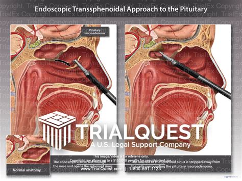 Endoscopic Transsphenoidal Approach To The Pituitary TrialExhibits Inc