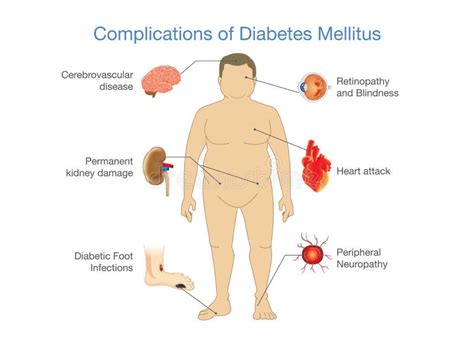 Complications Of Diabetes Mellitus Stock Vector Illustration Of