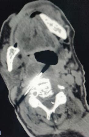 Image Guided Interventions In Head And Neck Radiology Key