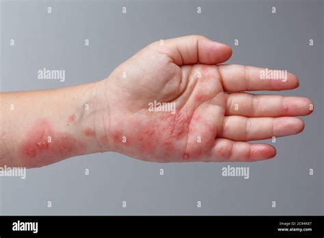 Gürtelrose Zoster oder Herpes Zoster Symptome am Arm Stockfotografie