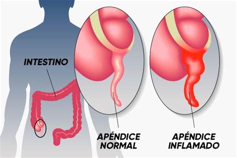 Apendicitis Qu Es S Ntomas Causas Y Tratamiento Tua Sa De