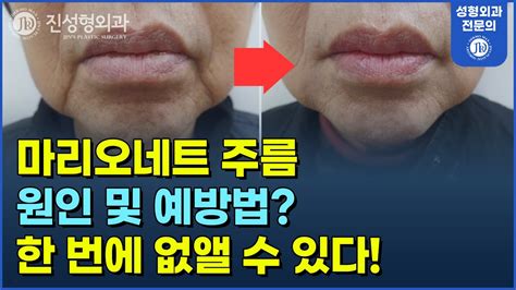 마리오네트 주름이 생기는 이유 없애는 시술 알려드릴게요 YouTube