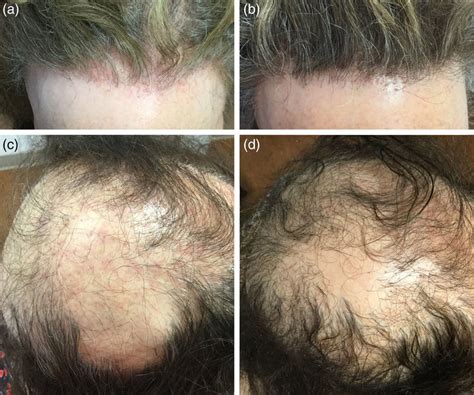 Frontal Fibrosing Alopecia