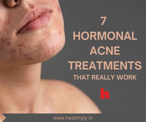 7 Tried Tested Hormonal Acne Treatments That Really Work