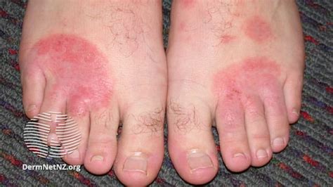 Evalúan dos biofármacos para la dermatitis facial de manos y pies