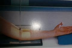 Chapter Upper Limb Projections Flashcards Quizlet