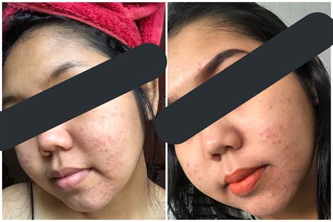 KINDLY CHECK PINNED TWEET WOMANFEEDS On Twitter Acne Mu