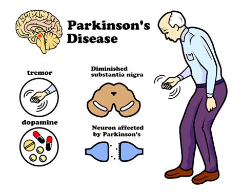 Parkinson S Disease Symptoms And Treatment Teletype