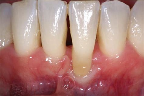 Gum Grafting Huntington Beach Cosmetic Periodontics Dr Braga