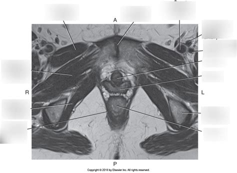 Coronal Mri Female Pelvis Diagram Quizlet