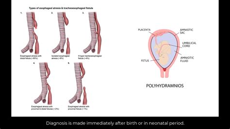 Types Of Esophageal Atresia And Tracheoesophageal Fistula Youtube