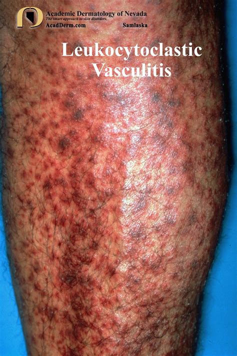 Leukocytoclastic Vasculitis Small Vessel Vasculitis Academic Dermatology Of Nevada