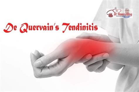 De Quervains Tendinitis Tendinitis Quervain