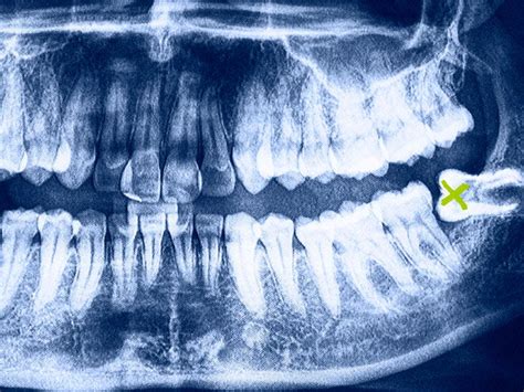 Impacted Molar Giganet Sampa Br
