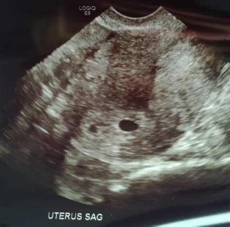 Ultrasound Pictures Of Twins At Weeks Picturemeta