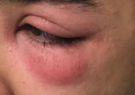 Periorbital Cellulitis Contagious