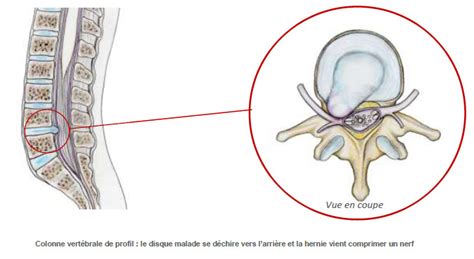 Hernie Discale Lombaire Fiches Patients Espace Patients Fasterspine