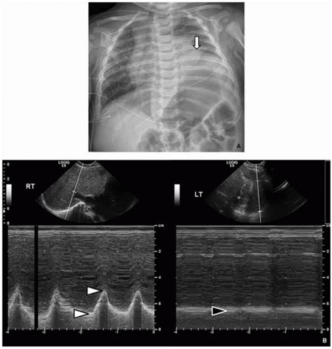 Diaphragm Radiology Key