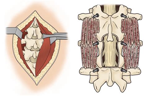 Open Spine Surgery