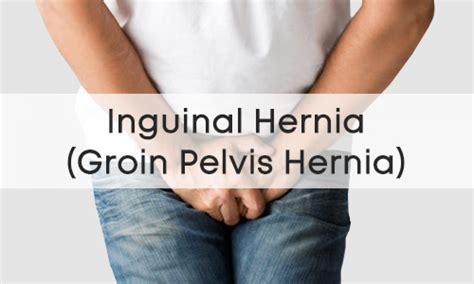 Direct Indirect Inguinal Hernias Symptoms Causes And 54 OFF