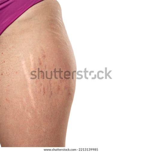 Female Hip Stretch Marks Groin Dots Stock Photo Shutterstock