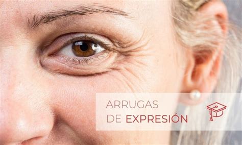 Qué son las Arrugas de Expresión y cómo se tratan Sefhor
