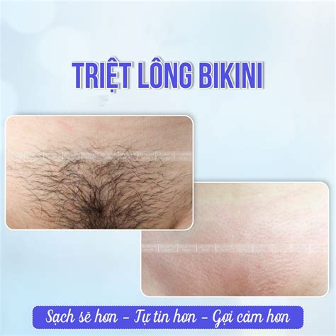 Triệt Lông Bikini Tạo Hình 12 Mẫu Lông Hot Đẹp Năm 2023