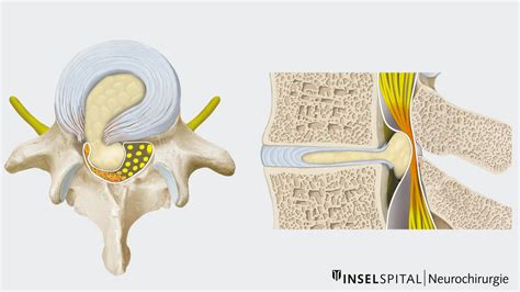 Les Hernies Discales Neurochirurgie Inselspital Bern