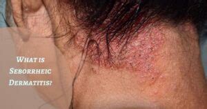 What Is Seborrheic Dermatitis Homeo Care Clinic Pune