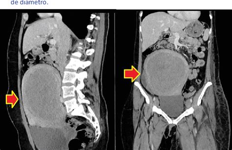 Figure From Linfedema De Miembro Inferior Como Debut Cl Nico De Mioma