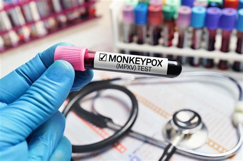 La viruela del mono declarada Emergencia de Salud Pública de