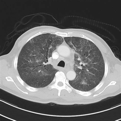 Radiopaedia Case Pneumocystis Jiroveci Pneumonia Id 40244 Study 42786