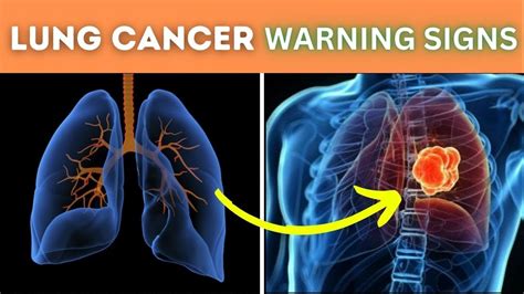 Lung Cancer Signs And Symptoms Youtube