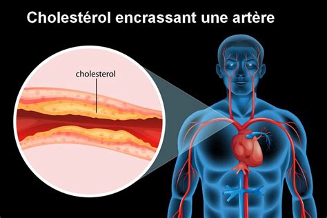 Cholestérol total LDL HDL taux élevé bas c est quoi