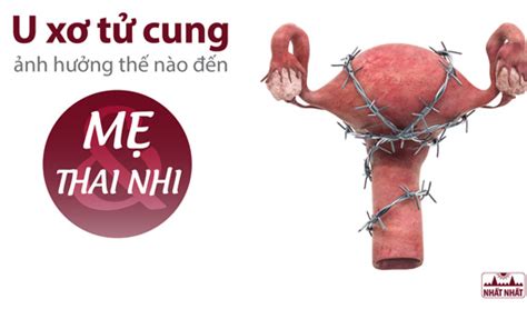 U xơ tử cung khi mang thai ảnh hưởng tới thai nhi như thế nào