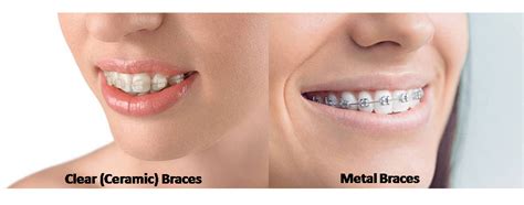 Best Orthodontist In South Delhi BRACES WITHOUT EXTRACTION