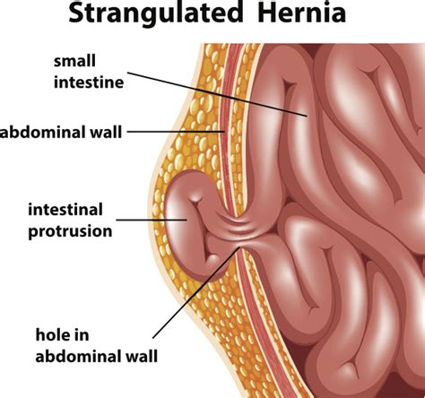 Hernia Diagram Of Inside Umbilical And Inguinal Hernia Men With Hernia