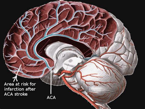 Figure Anterior Cerebral Artery Stroke Image Courtesy S Bhimji MD