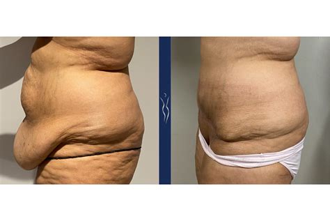Fleur De Lis Tummy Tuck