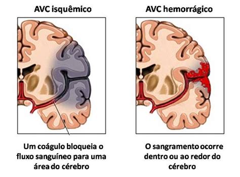 Sinais E Sintomas De Um Acidente Vascular Cerebral AVC Physioclem