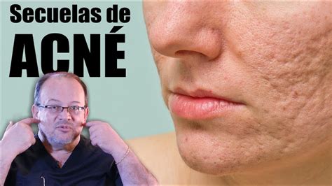 SECUELAS de ACNÉ TRATAMIENTO para ATENUAR las CICATRICES Láser CO2