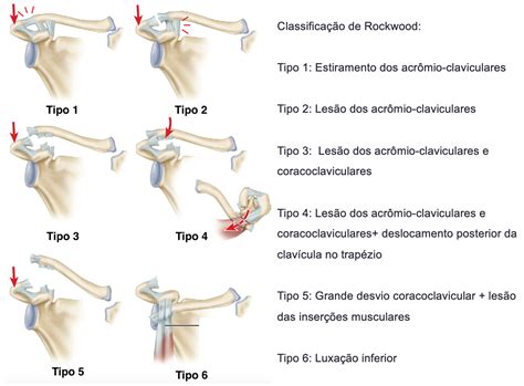 Luxação acrômio clavicular do ombro Dr Artur Utino Membro do grupo
