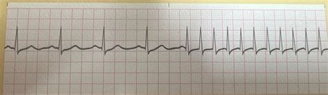12 Lead EKG Flashcards Quizlet