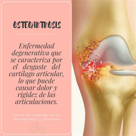 La Osteoartrosis Es Una Enfermedad Degenerativa Que Afecta A Las
