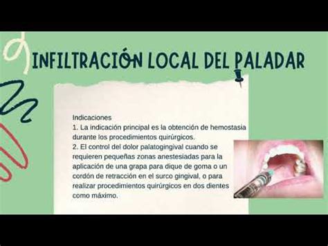 T Cnicas Anest Sicas Del Paladar Del Maxilar Youtube