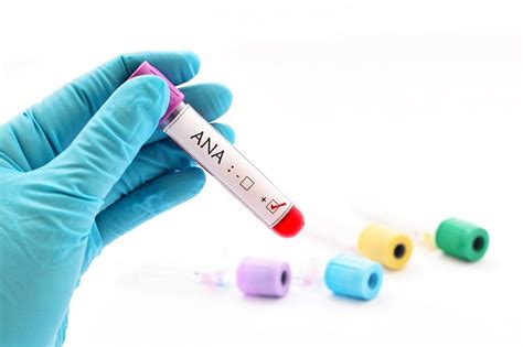 Tes ANA Ini Yang Harus Anda Ketahui Alodokter
