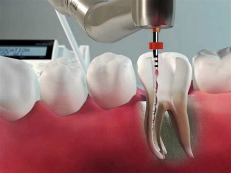 Tudo o que você precisa saber sobre Endodontia https