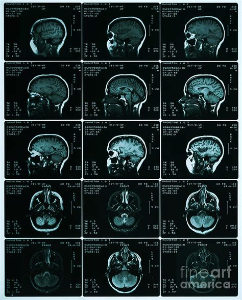 Mri Of Normal Brain Photograph By Science Source Fine Art America