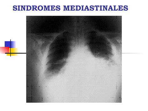 Sindromes Mediastinales PPT