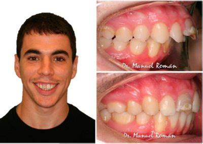 Caso Clinico Del Mes Septiembre 2013 Biprotrusion Dental Ortodoncia